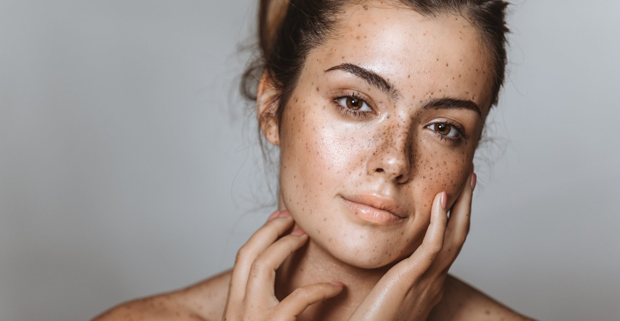 Sunspots vs Freckles – Explained by a Dermatologist - Talking Tan